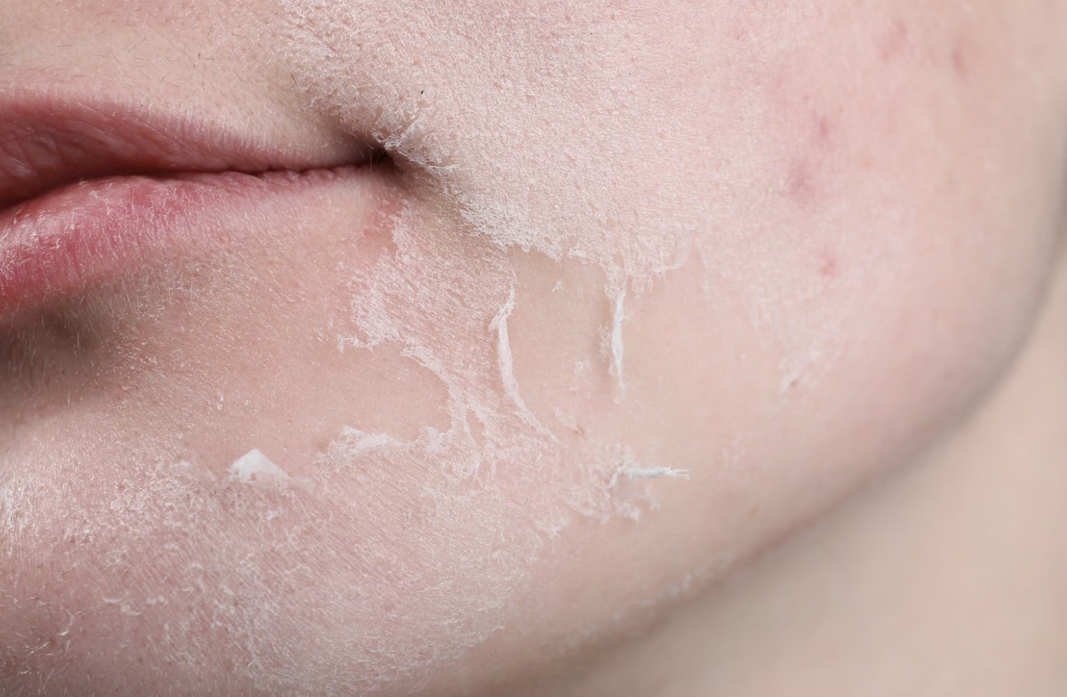 A Guide to TCA Chemical Peel: Benefits, Recovery, and Results | Formula ...